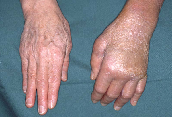 Complex regional pain syndrome