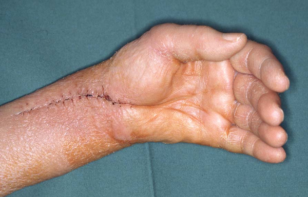 Complex regional pain syndrome