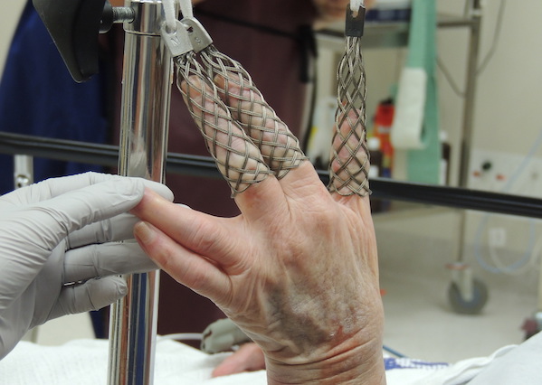 Distal radius fracture