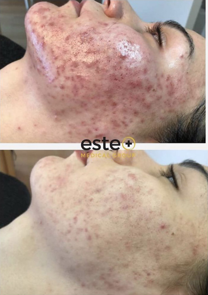 Acne | Types of Acne | Causes & Treatment – Este Medical Group
