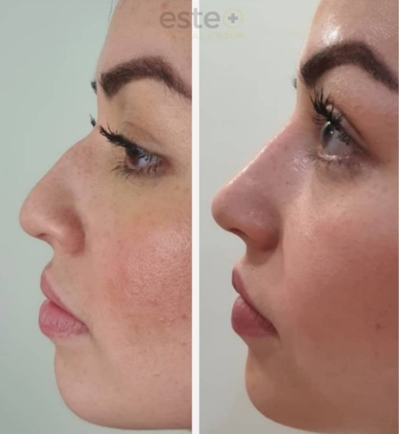 Crooked Nose | Causes & Treatment for Bumps – Este Medical Group