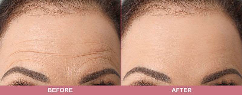 Frown Lines | Causes & Treatment of Wrinkles – Este Medical Group
