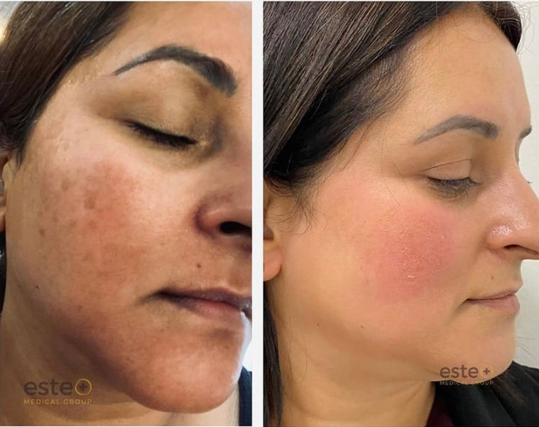 Age Spots | Causes & Treatment – Este Medical Group