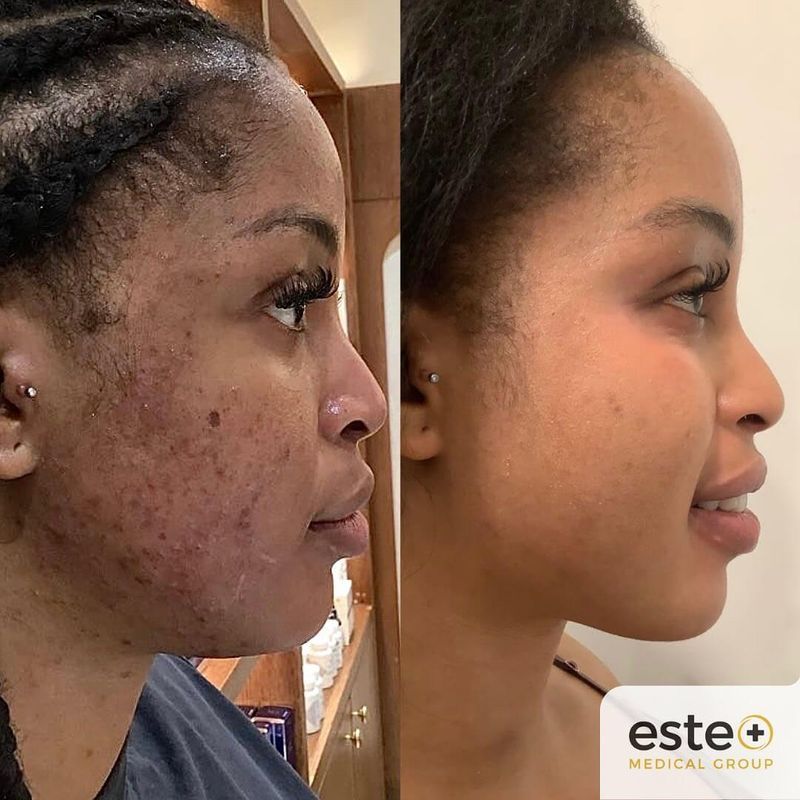 Hyperpigmentation | Este Medical Group
