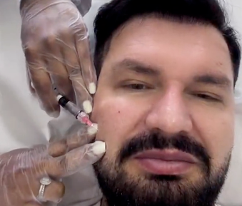 Non-Surgical Nose Job | Este Medical Group