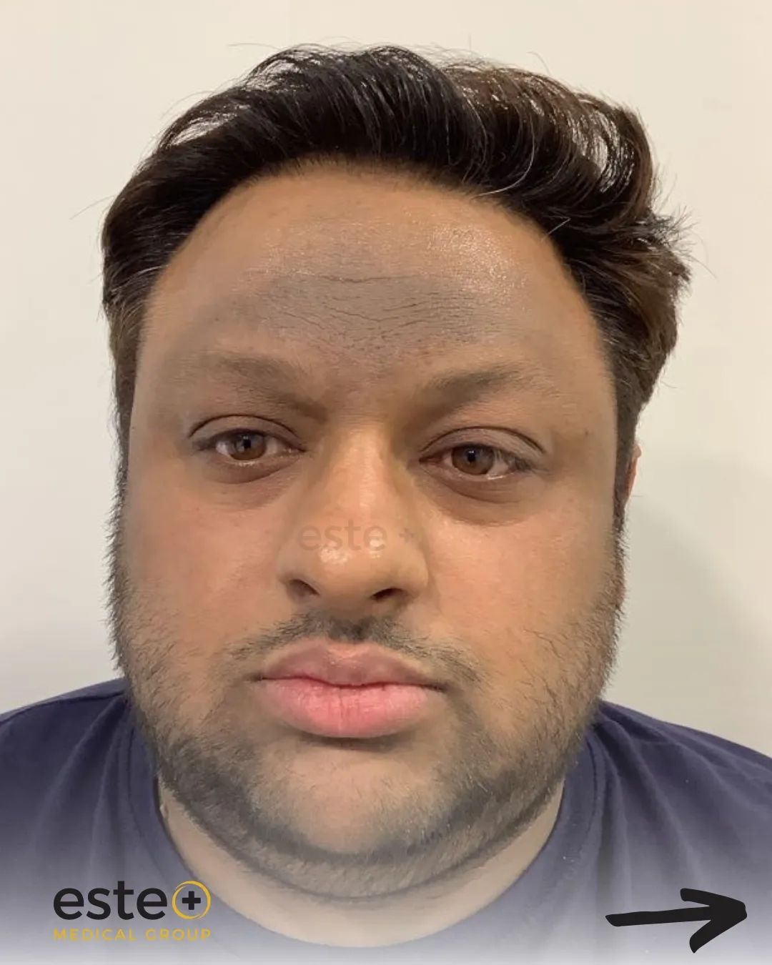 Man’s Face Transformed By Pigmentation Treatment - Este