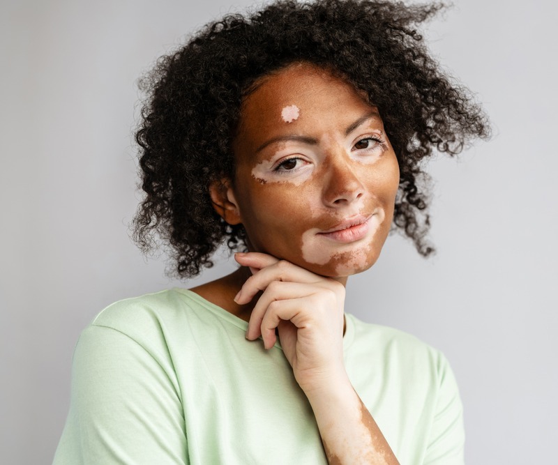 Leukoderma | Vitiligo Skin Condition - Este