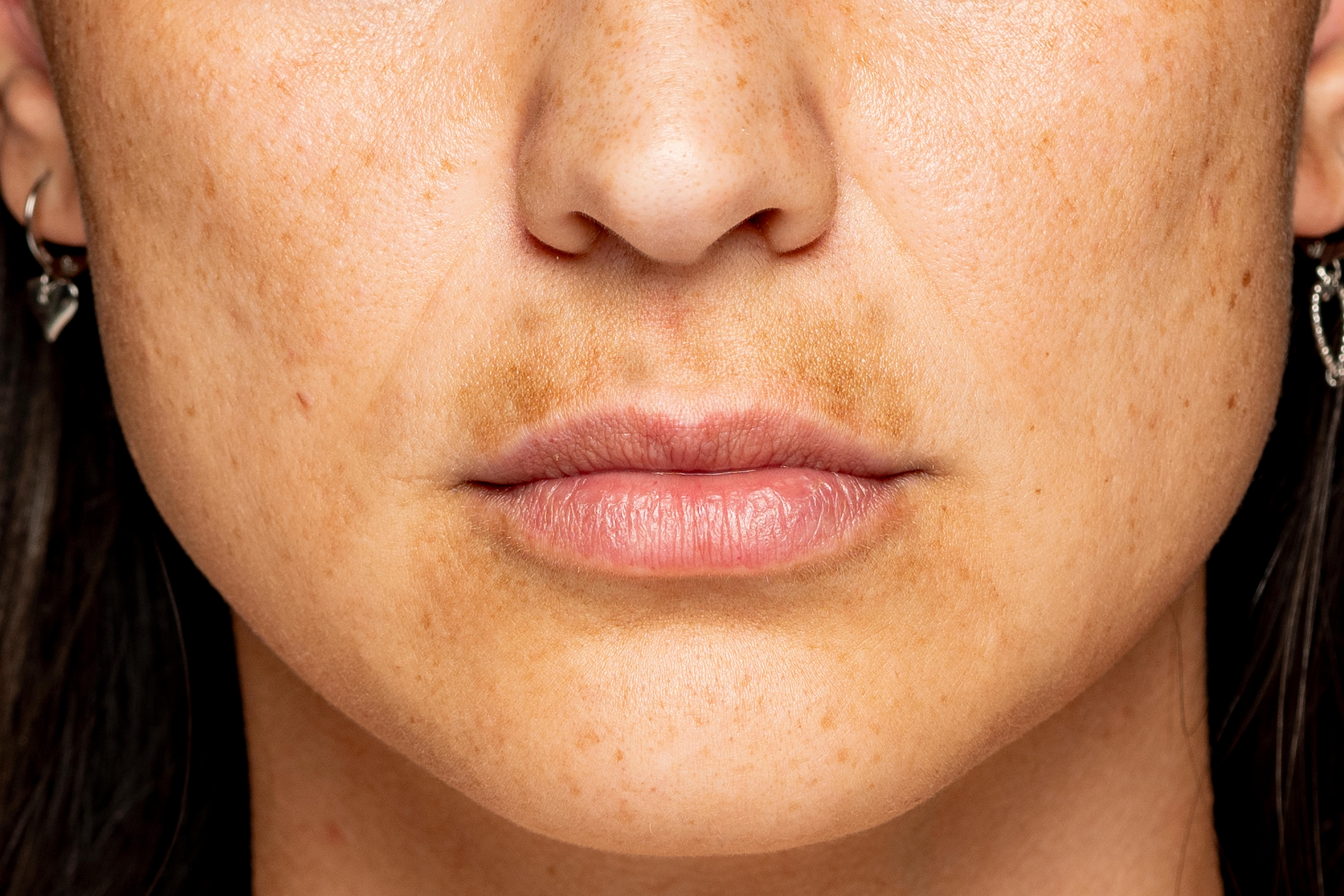 Hyperpigmentation Birmingham What You Need To Know Este Hyperpigmentation Birmingham What You Need To Know Este