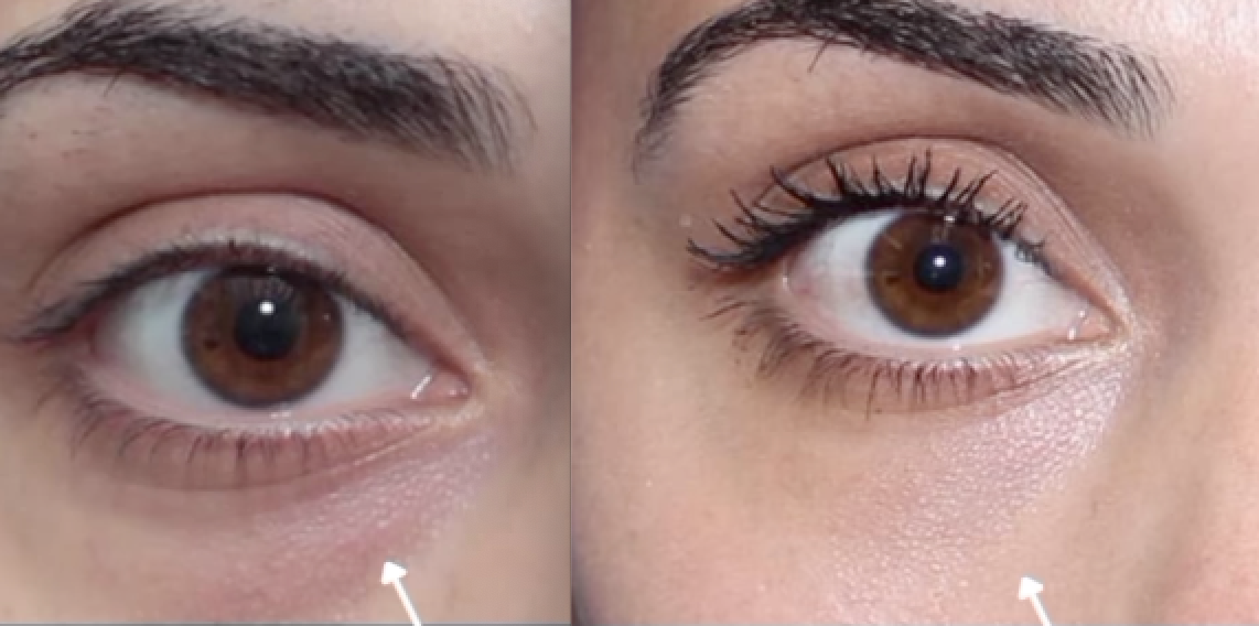 Dramatic Before-and-After Tear Trough Filler Photo! - Este