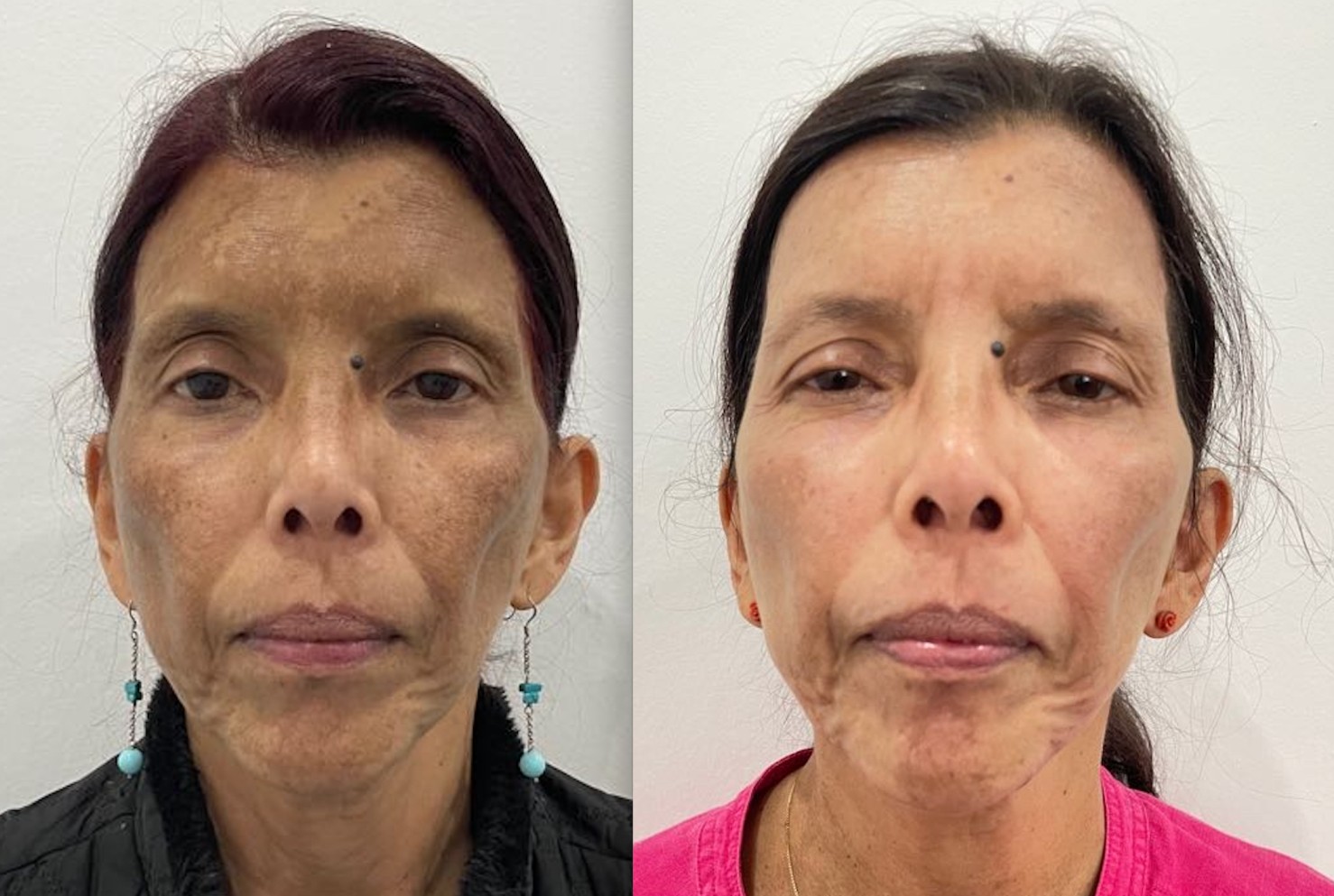 Dramatic Before-and-After Tear Trough Filler Photo! - Este