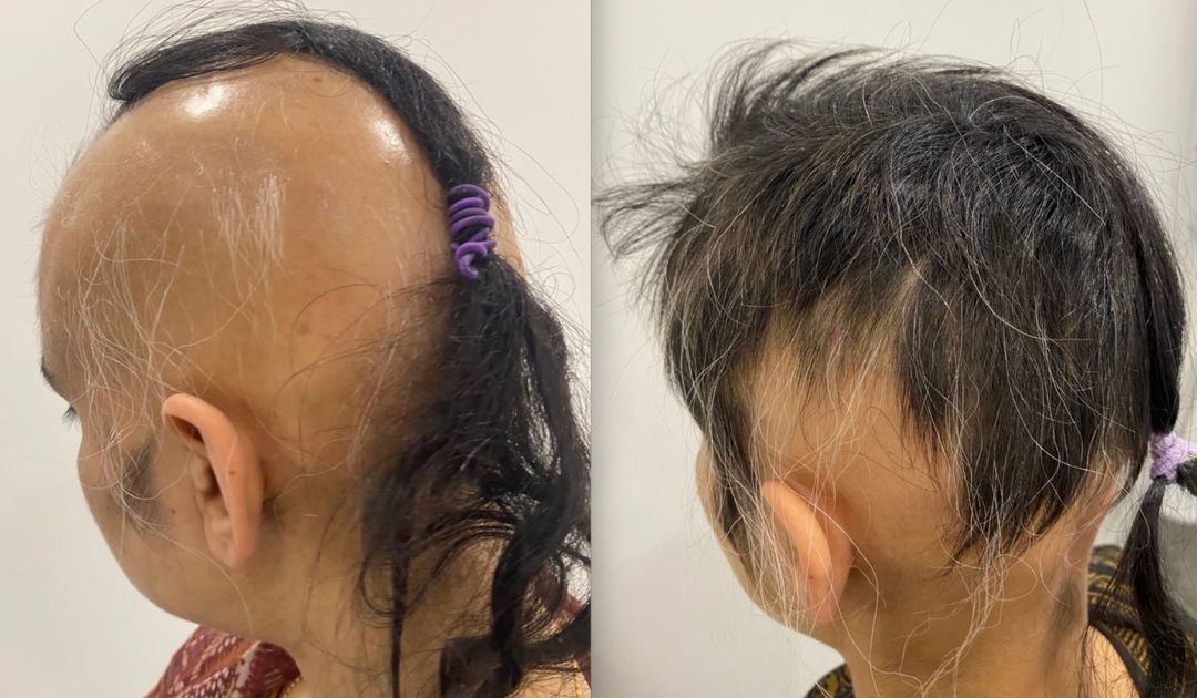 Extreme Female Baldness: Before & After Photos - Este