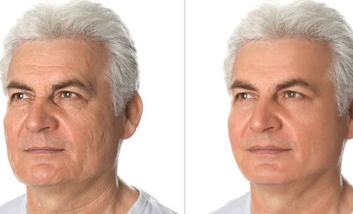 Pebble Chin | Causes & Treatment of Chin Dimple – Este Medical Group