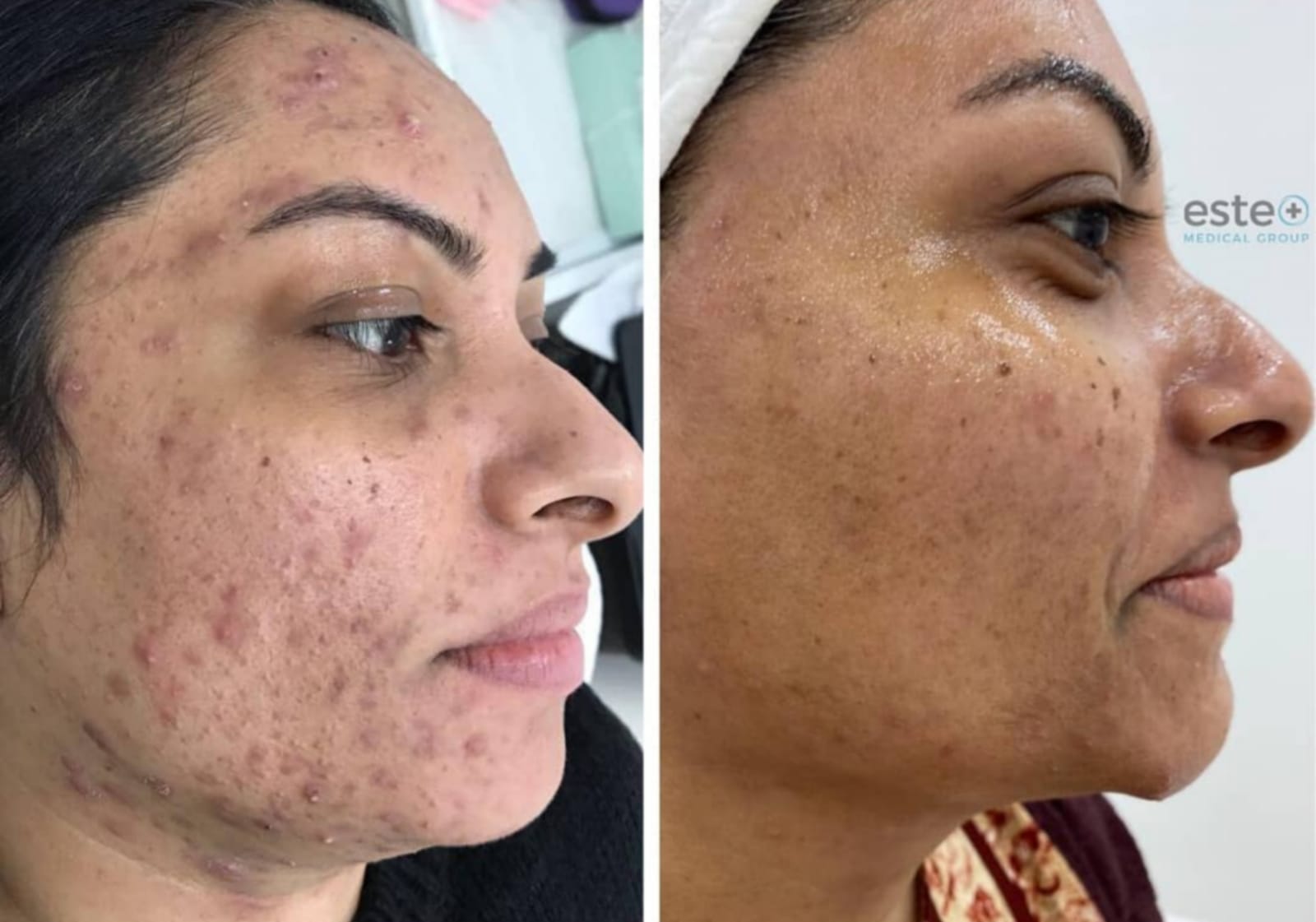 Photo Damaged Skin | Causes & Treatment – Este Medical