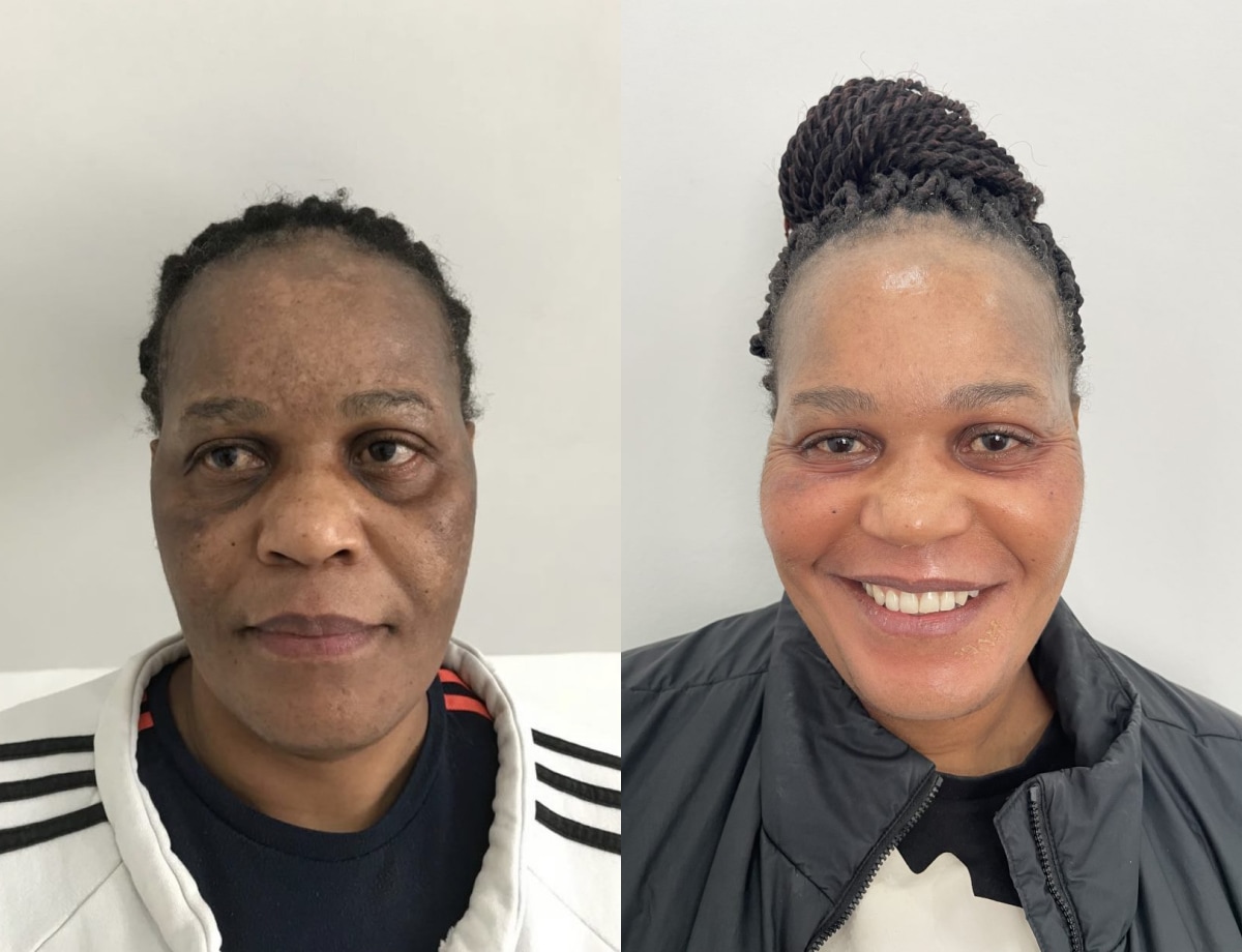 Melasma | Causes of Melasma - Este