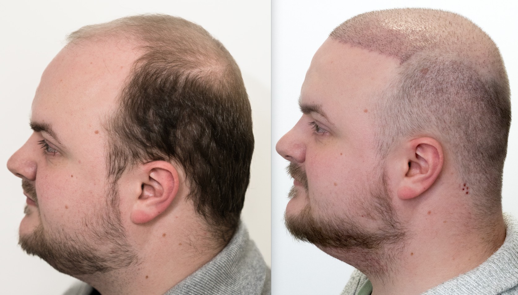 Oxygen Therapy After Hair Transplant at Molly Nielsen blog