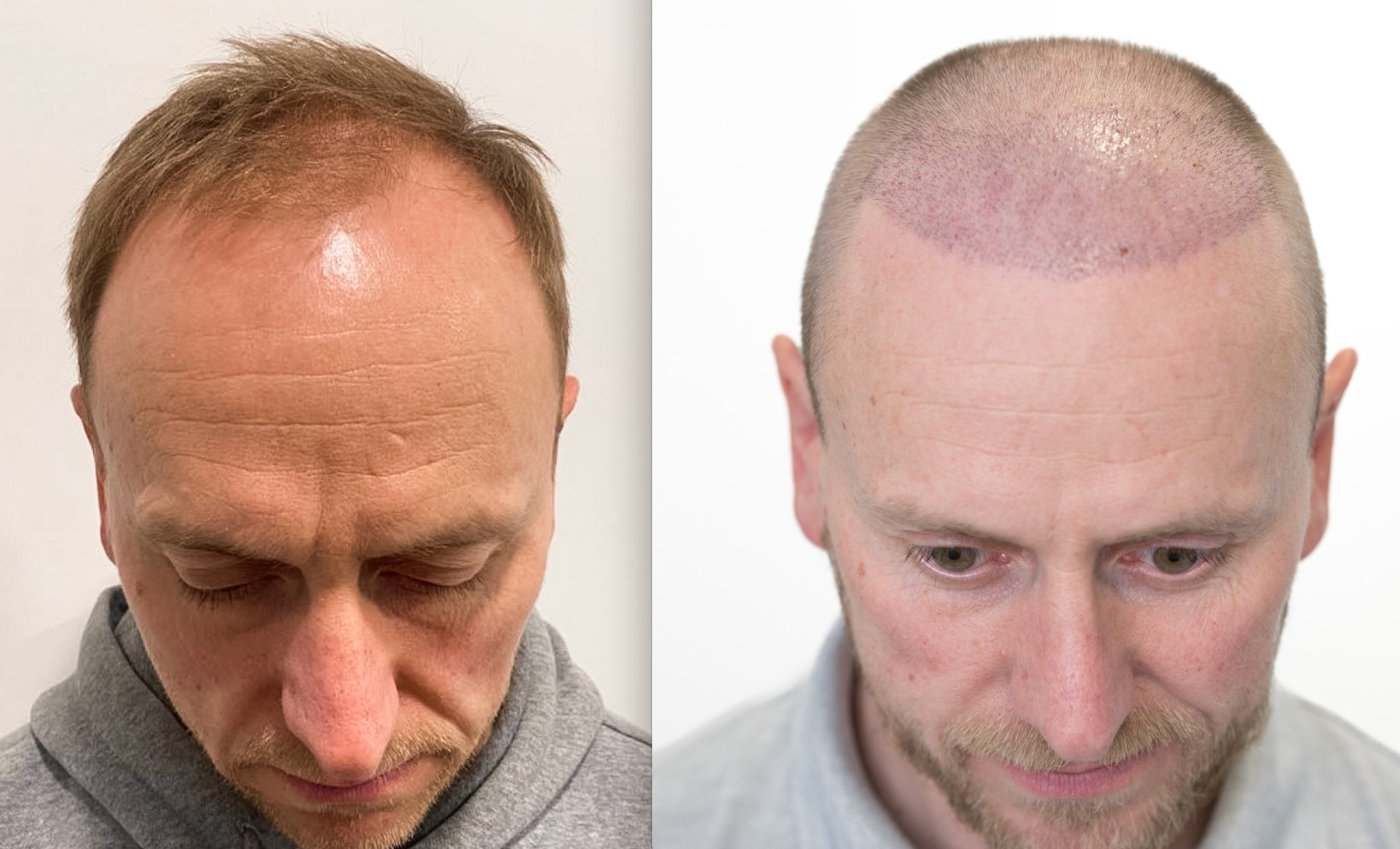 Simon Just Had Successful Hair Transplant With Este! - Este