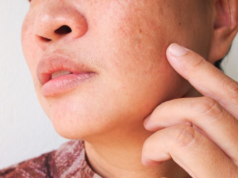 Can PCOS Cause Skin Pigmentation? Yes, Here's a Treatment to Remove - Este