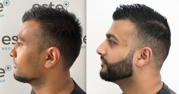No Beard To Full Beard: Leeds Man Has Successful Beard Transplant - Este