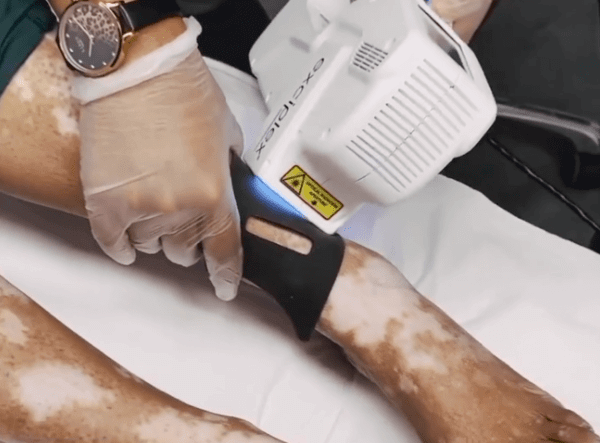 Vitiligo Skincare Treatment with Exciplex Light Therapy - Este