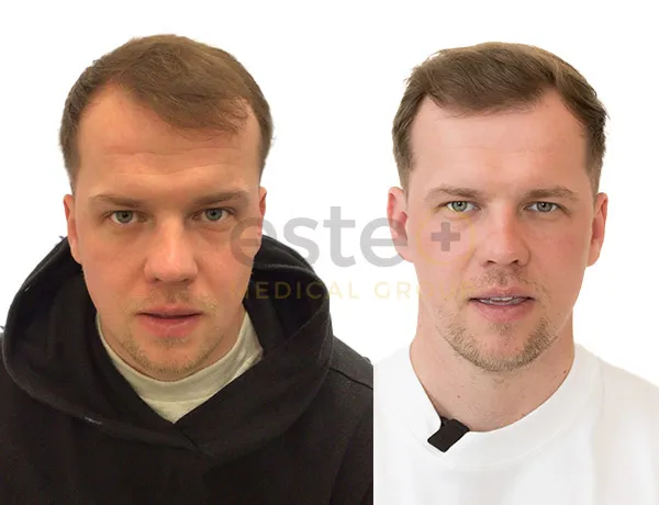 Results After 6-Months! Glasgow Man Regrows Hair With PRP & Laser Therapy