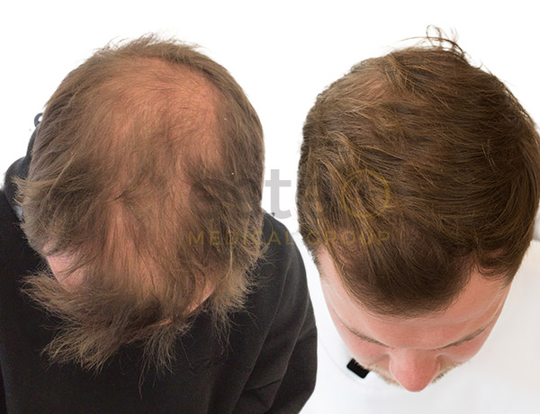 Results After 6-Months! Glasgow Man Regrows Hair With PRP & Laser Therapy