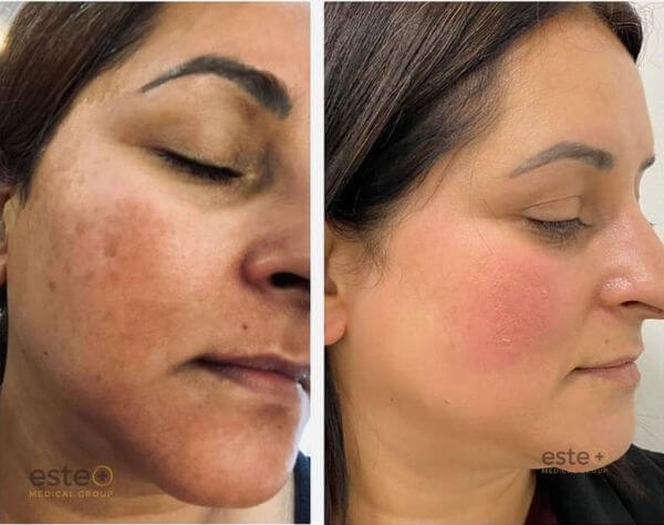 Age Spots | Causes & Treatment – Este Medical Group