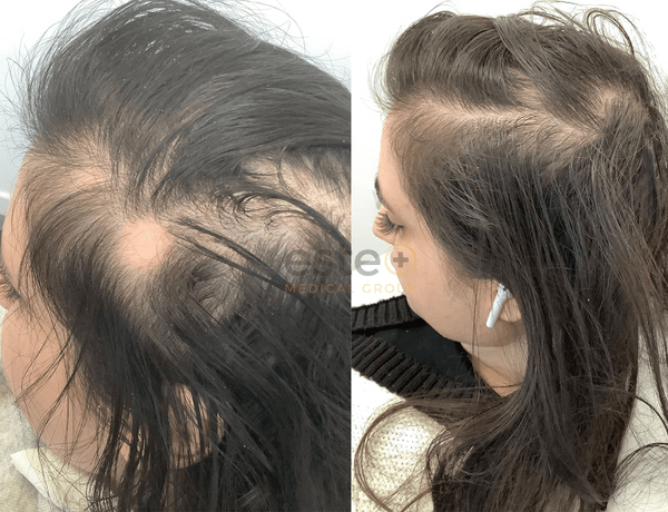What is PRF Treatment? Does PRF Work for Hair Loss? - Este