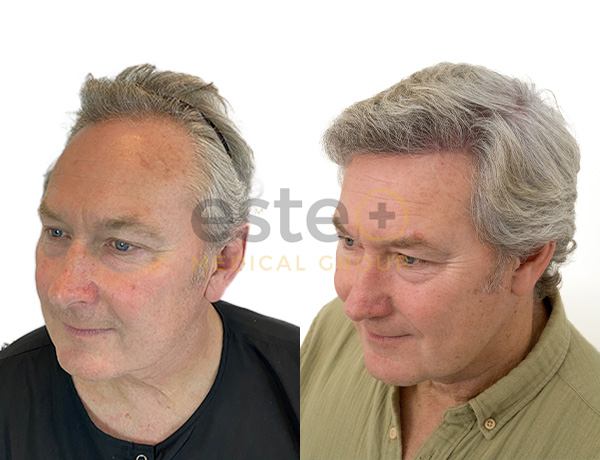60-Year-Old Graham’s Amazing Hair Transplant Results After Only 8 Months