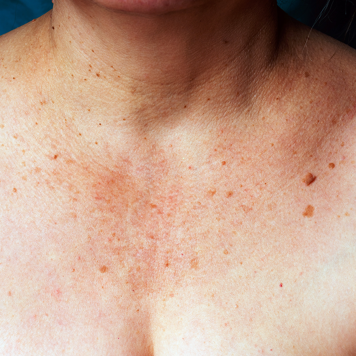Sun Damaged Skin Spot Check Skin Cancer Aesthetics Melbourne CBD