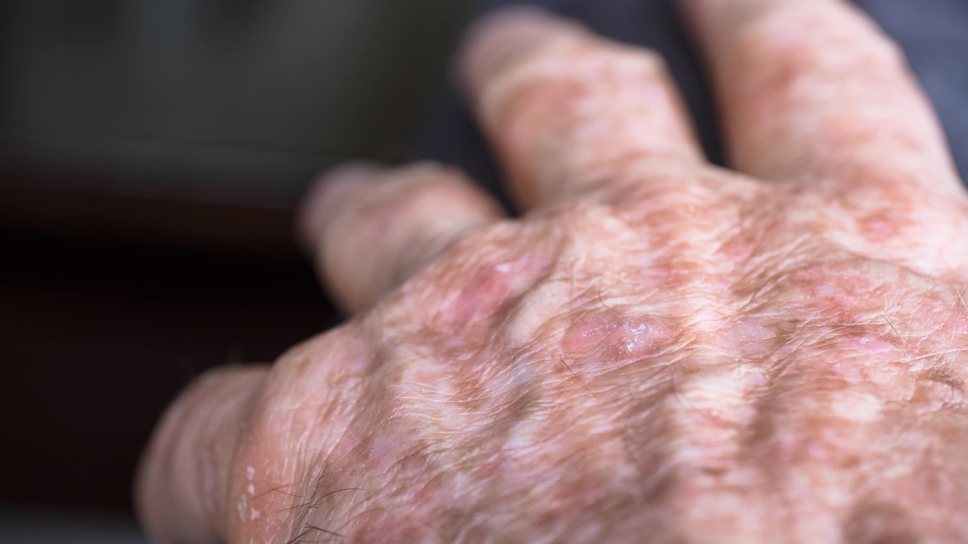 Solar keratoses | Spot Check: skin cancer + aesthetics. Melbourne CBD