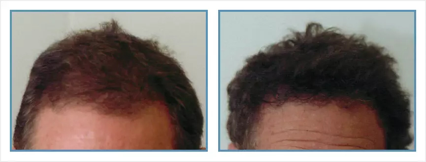 Hair Transplants for Men at the Hair Restoration Center of NJ & NY
