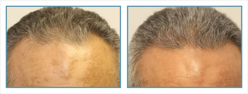 Hair Transplants for Men at the Hair Restoration Center of NJ & NY