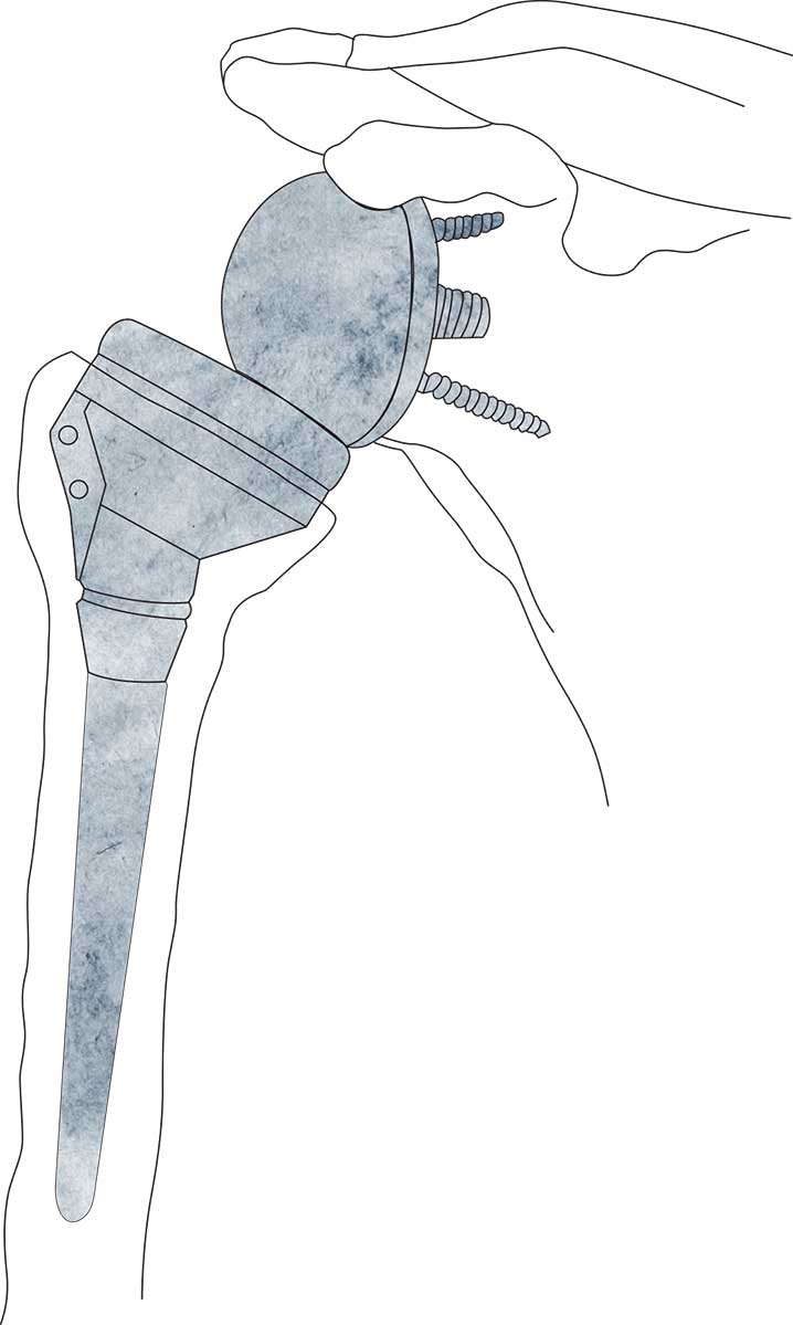 Reverse Total Shoulder Replacement - Shoulder Clinic