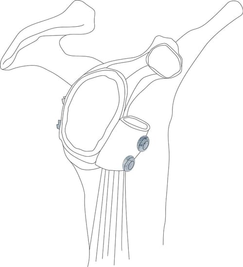Shoulder Surgery - Shoulder Clinic