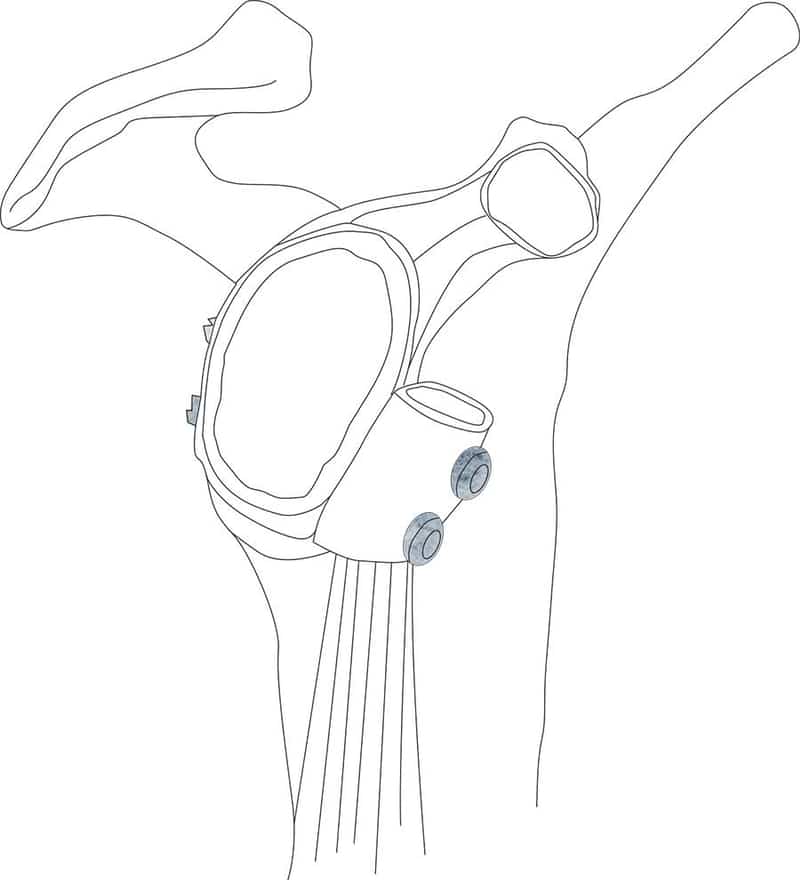 Shoulder Surgery - Shoulder Clinic