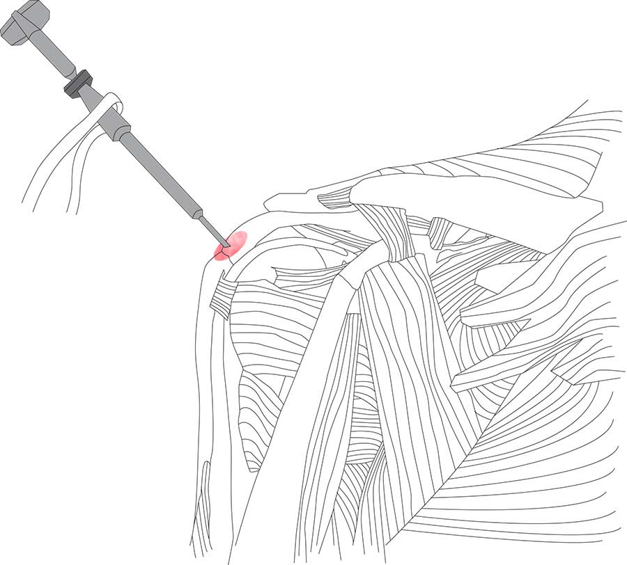 Shoulder Surgery - Shoulder Clinic