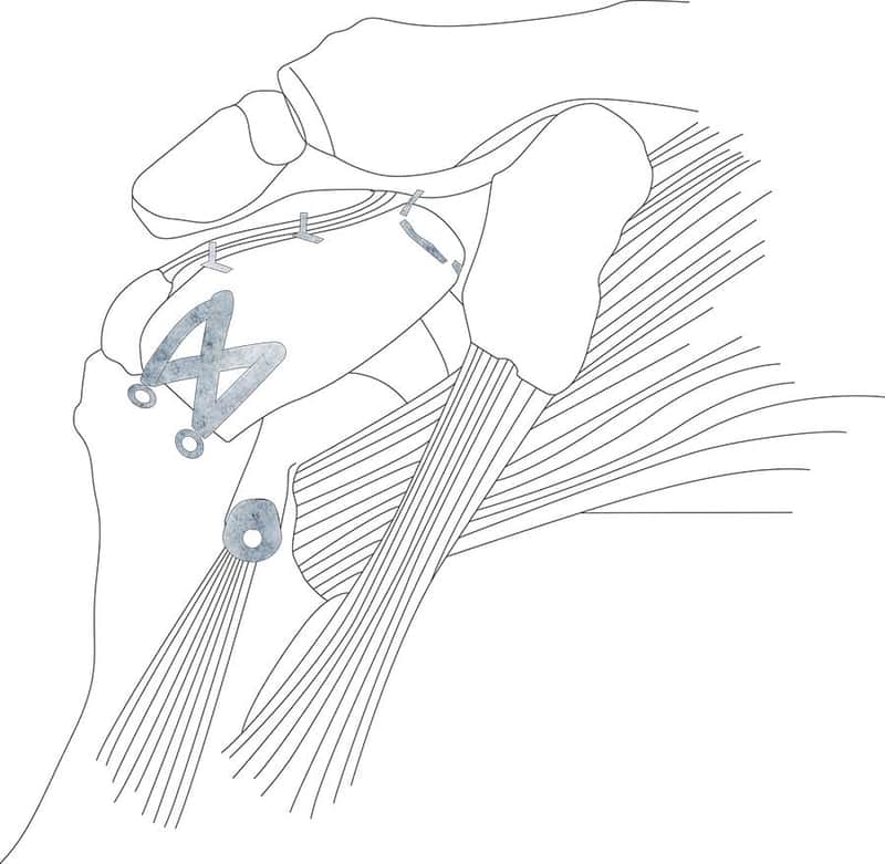 Shoulder Surgery - Shoulder Clinic