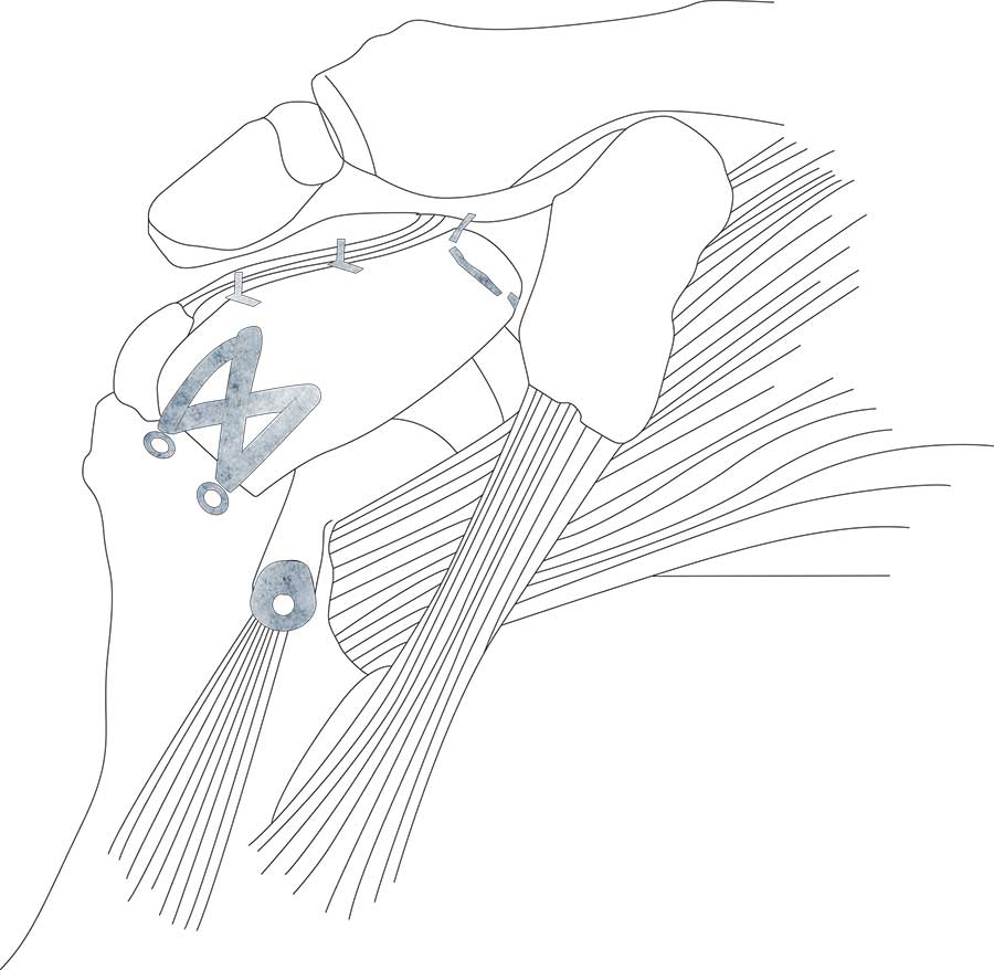 Shoulder Surgery - Shoulder Clinic