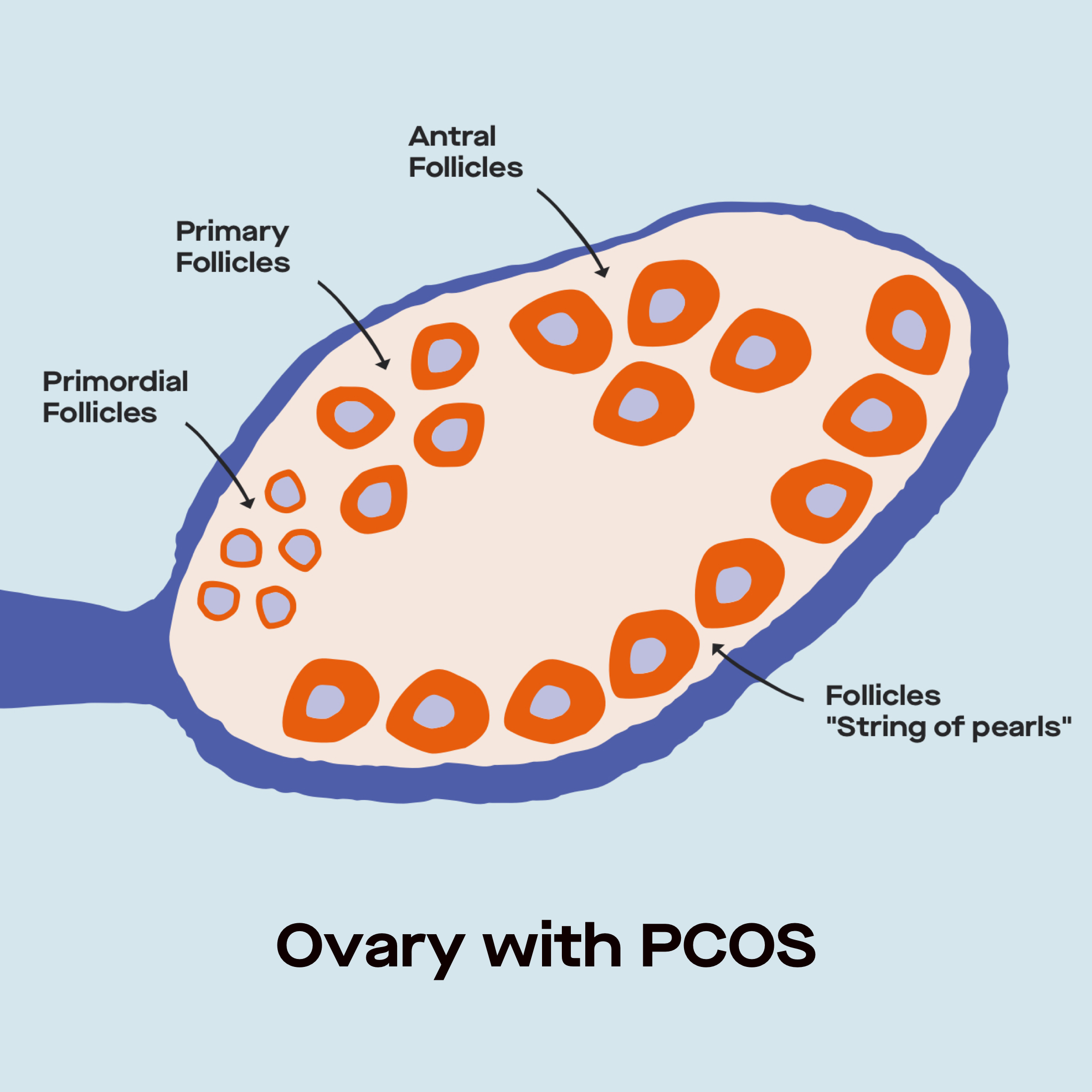 PCOS: How hormone tests can help with diagnosis