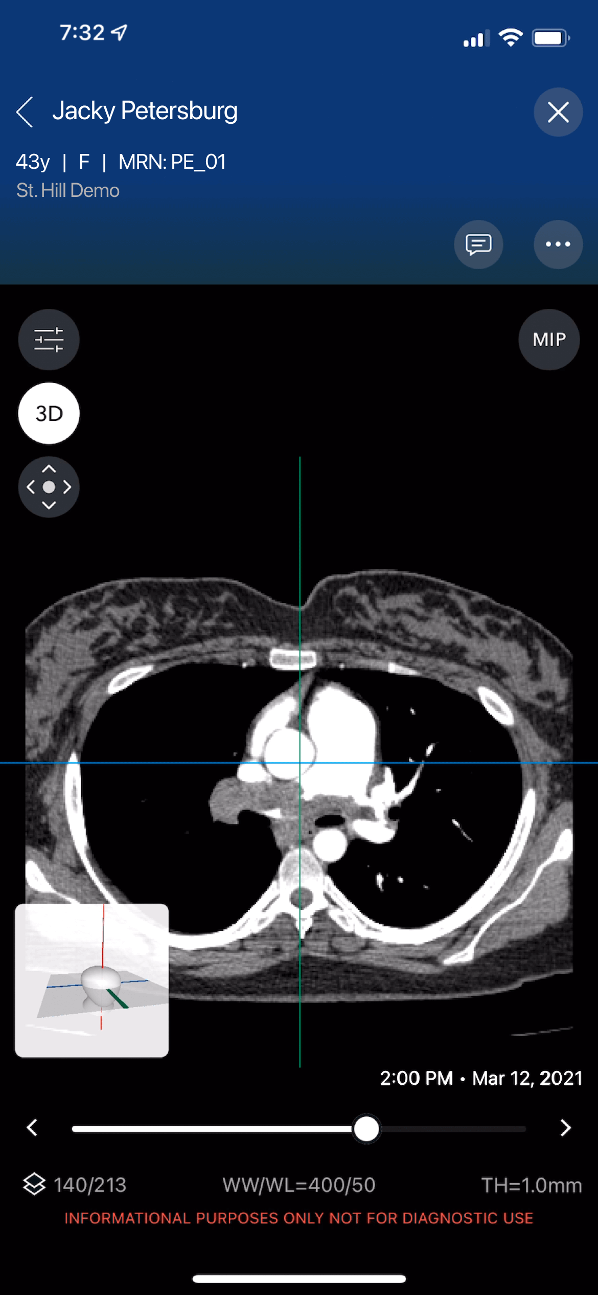 Viz PE - AI-powered care coordination for pulmonary embolism