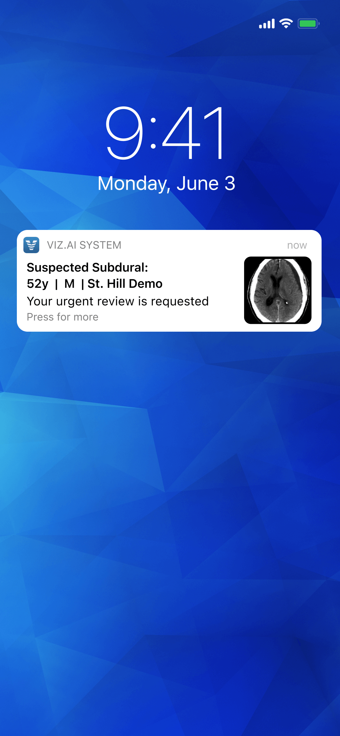 Viz™ SUBDURAL - AI-powered subdural care coordination