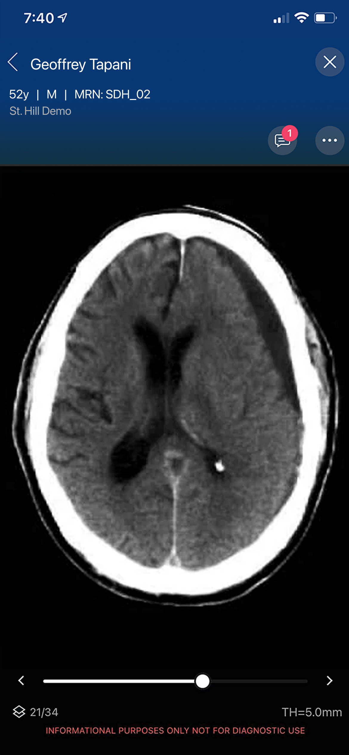 Viz SUBDURAL