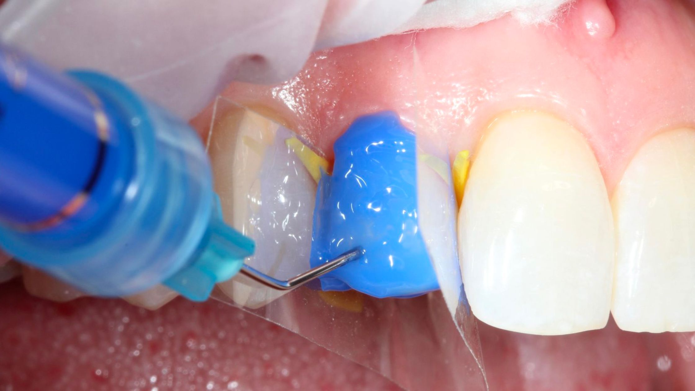 How Does Acid Etching Enhance My Dental Restorations? | Dental Image ...