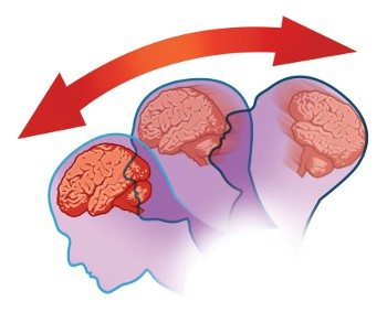 Blog - 5 Signs You Might Have a Concussion