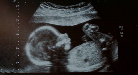 First Trimester Scan - The Nuchal Translucency Scan | Cloudnine Blog