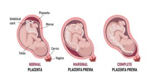 Signs of Placenta Previa