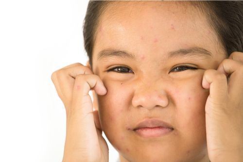 Scratching the Surface: How to Manage Your Child's Chickenpox