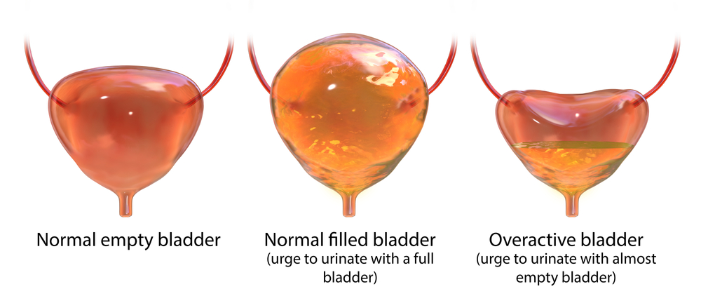 Overactive Bladder | Cloudnine Hospital