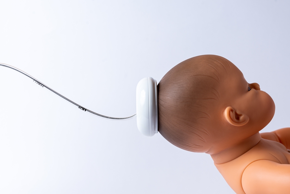 What is Vacuum-Assisted Delivery: What You Should Know About Vacuum ...