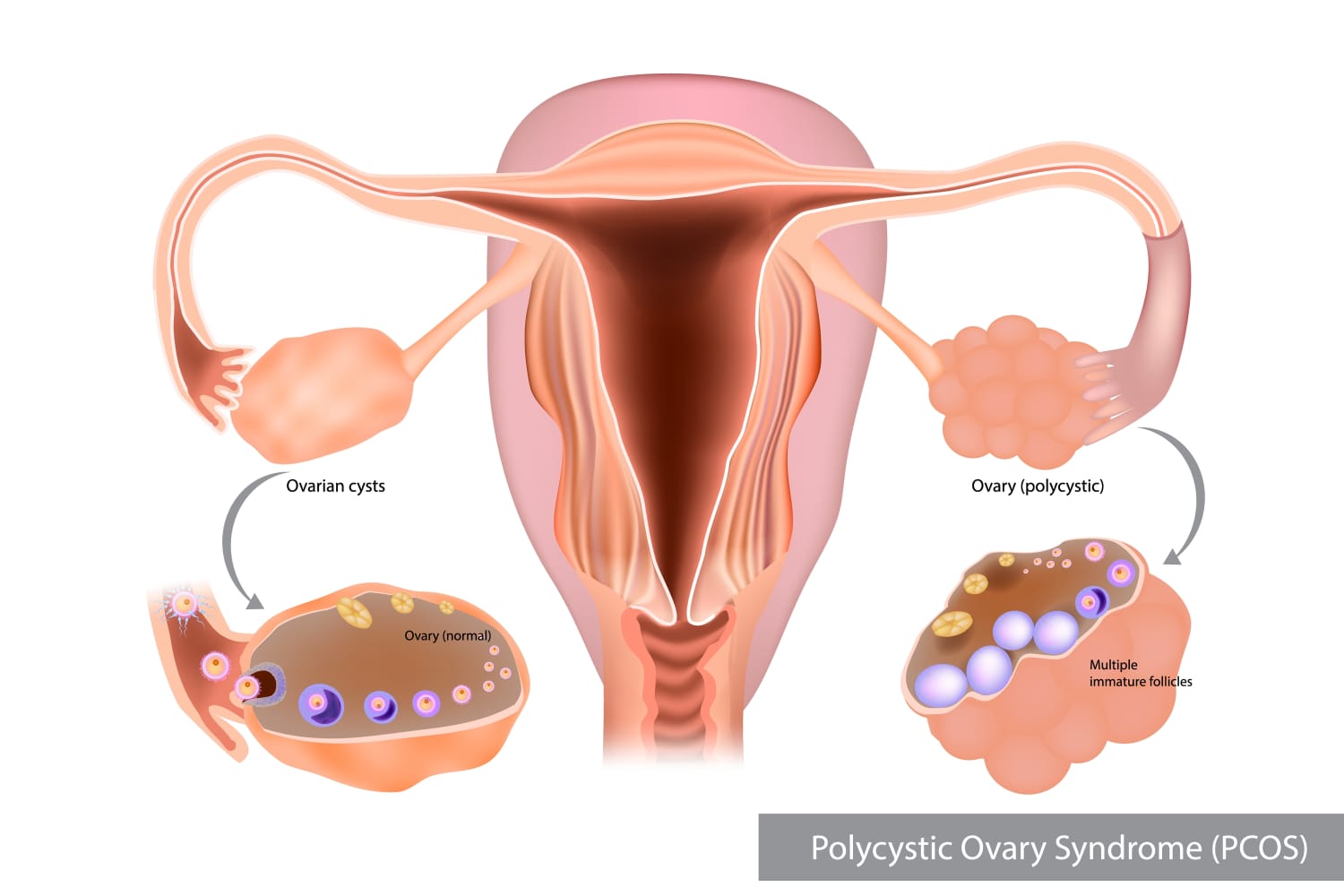 Understanding and Mitigating Long-Term Health Effects of PCOS